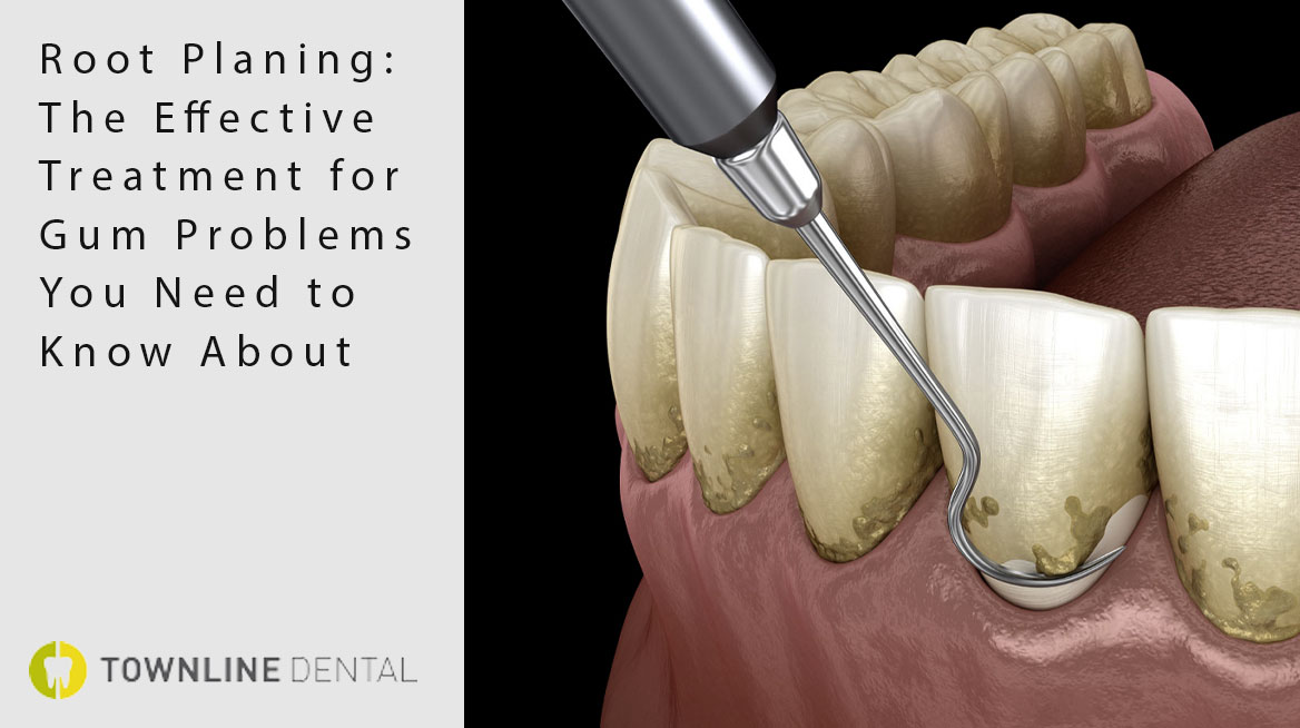 ‍Root Planing: The Effective Treatment for Gum Problems You Need to ...